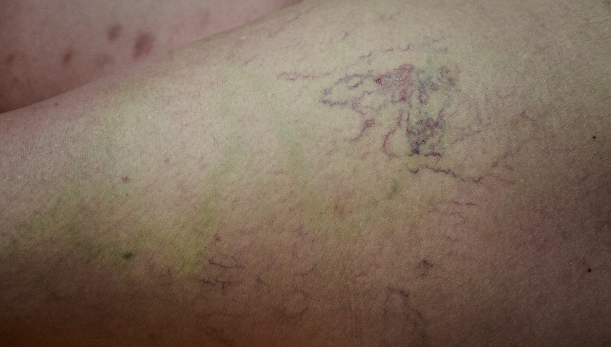 Telangiectasias y várices reticulares – Laser & Veins